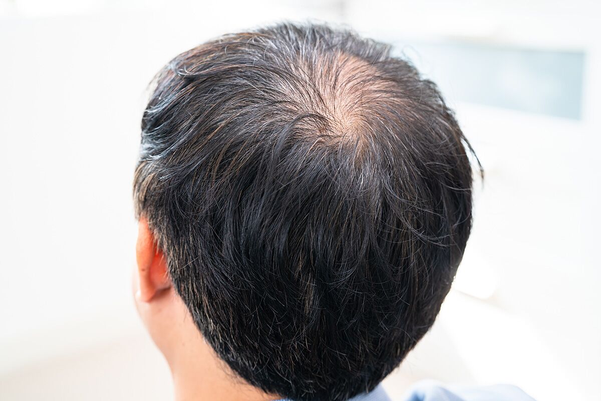 How I Stopped My Hair from Thinning: Proven Tips